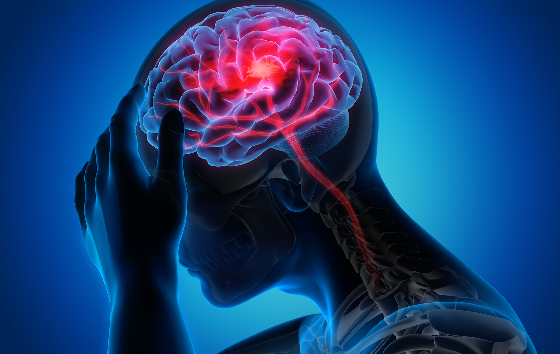 Apoplejía: Factores de riesgo, síntomas y tratamiento - Cardiología ...